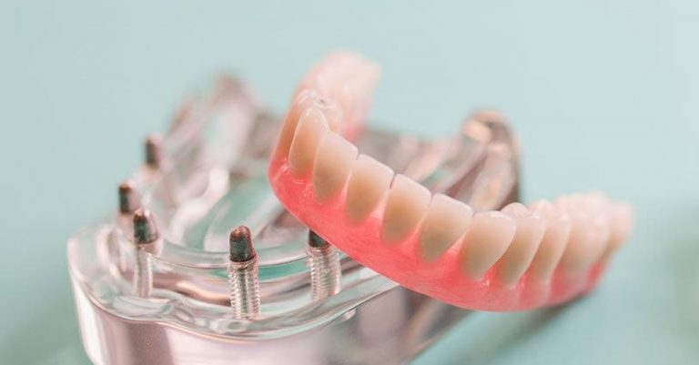 The Different Types of Dentures Available Today - Olds Denture ...